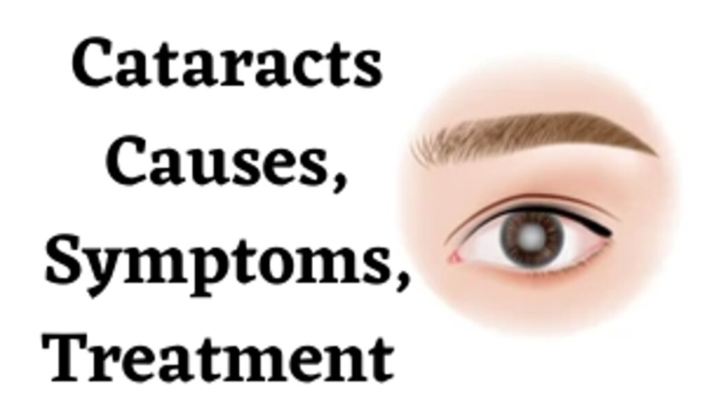 Cataracts - Causes, Symptoms, Risk Factors, Diagnosis, Treatment, and ...